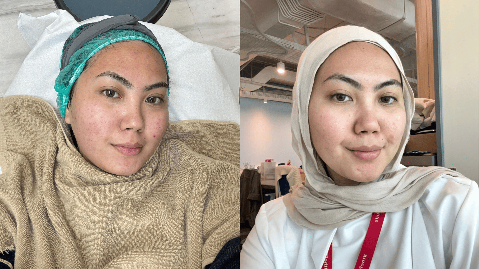 Female Daily Editorial - Review Pertama Kali Cobain DNA Salmon Micro Injection di ZAP Premiere ...