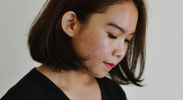 Female Daily Editorial - Bagaimana Sih Cara Mengatasi Komedo Tertutup?