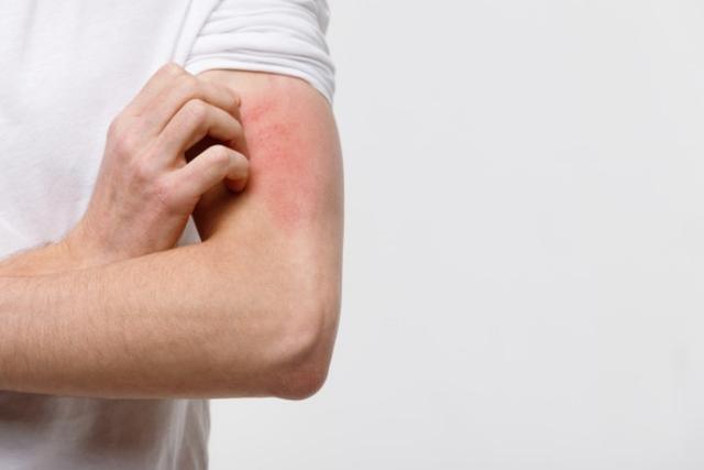 Kenalan dengan Pityriasis Rosea, Bercak Merah dan Bersisik di Kulit ...