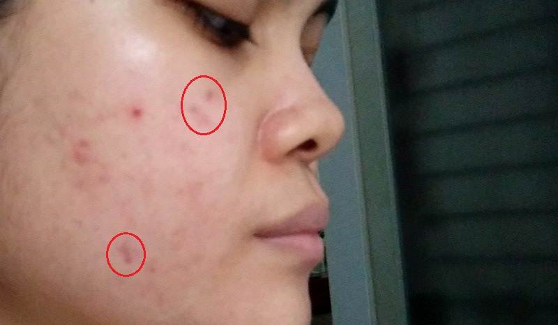 Female Daily Editorial - Mengenal Post Inflammatory Hyperpigmentation ...