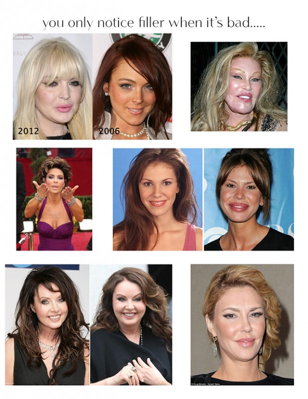 Female Daily Editorial - Ingin Filler? Kenali FOS (Facial Overfilled ...