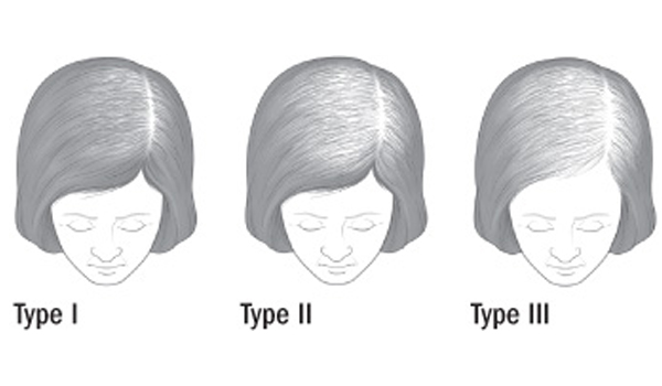 Female Daily Editorial - Kenapa Rambut Rontok? Ini Beberapa Penyebabnya