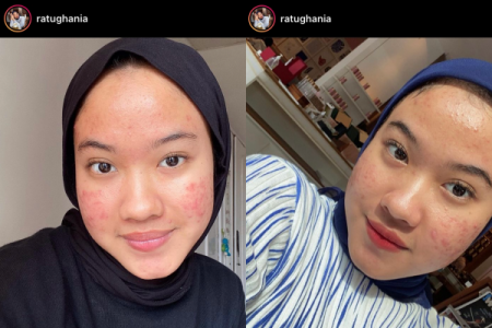 Female Daily Editorial - Inspiratif, Ini 6 Influencer Acne-Fighter yang ...