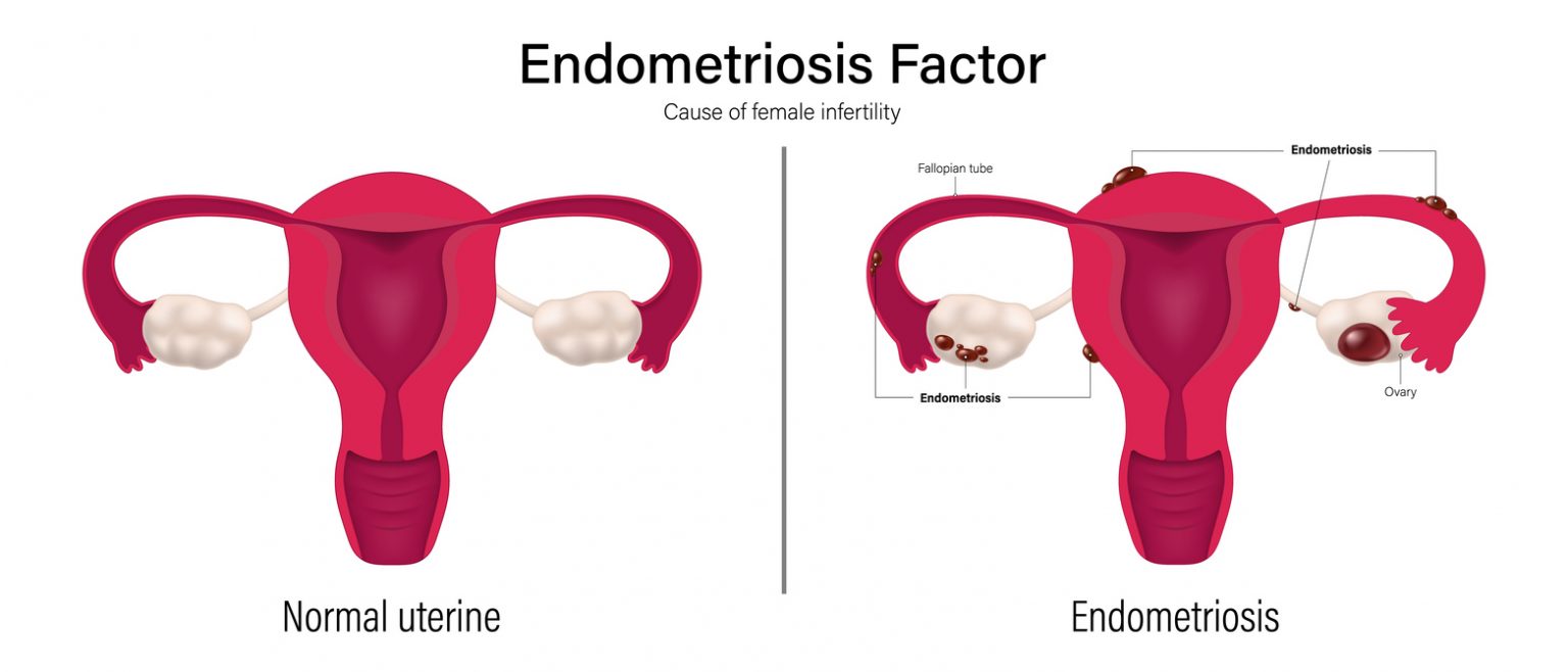 Female Daily Editorial - Ini Dia Gejala Endometriosis dan Penanganannya ...